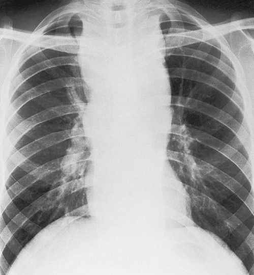 Radiology Pearls: TUBERCULOSIS