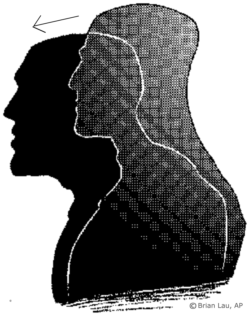 Ideal Balance Acupuncture: Head Forward Posture