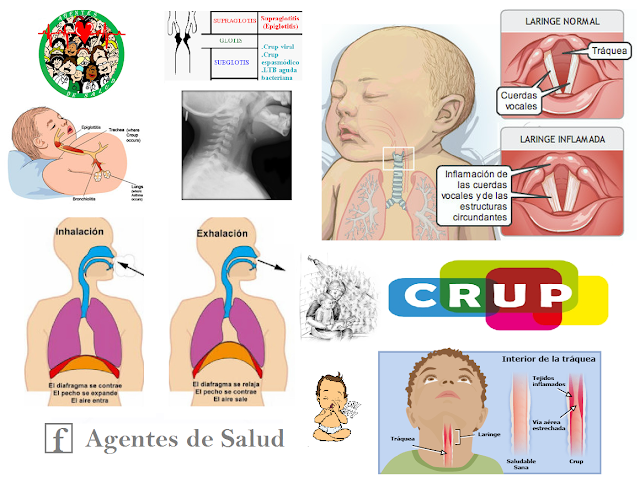 Agentes de Salud: Laringotraqueitis Obstructiva Aguda - CRUP