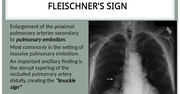 Chest Medicine Made Easy-Dr Deepu: Fleischners Sign