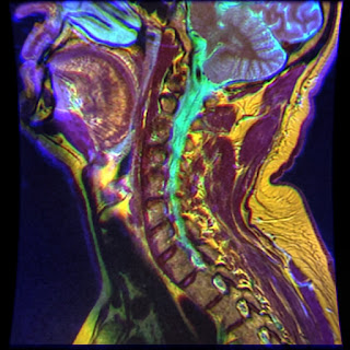 Nevit's blog: Color MRI of the Cervical Spine