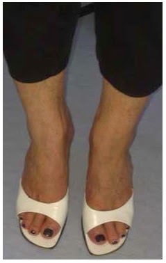 Deformiteti stopala: Čukljevi - Hallux valgus.