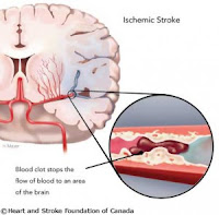 Pengertian Stroke Iskemik - Stroke Informations