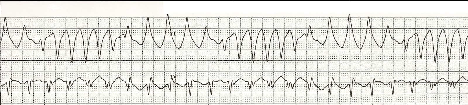 ACLS Rhythms: Ventricular rhythms