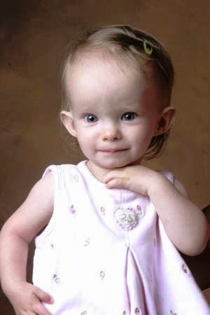 Síndrome de Russell-Silver - Definição, Causas, Sintomas, Diagnóstico ...