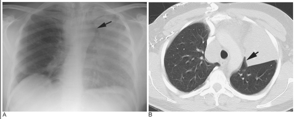 Diary of a PostGraduate in Radiodiagnosis: Luftsichel sign