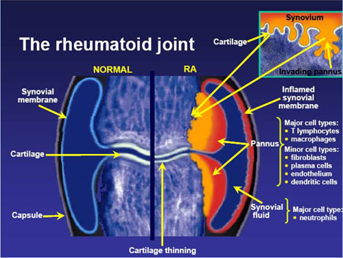 8 Signs of Rheumatoid Arthritis You May Not Know About