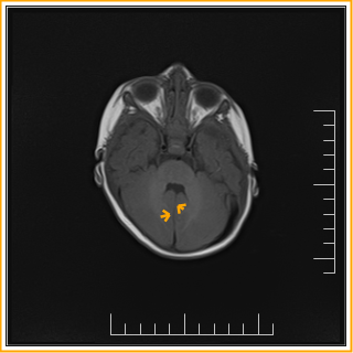 Joubert's Syndrome-MRI - Sumer's Radiology Blog