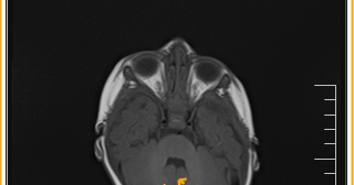 Joubert's Syndrome-MRI - Sumer's Radiology Blog
