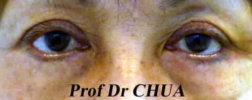 Eyelid Surgery by Prof Dr CN CHUA 蔡鐘能: Lower Lid Retraction - A Common ...