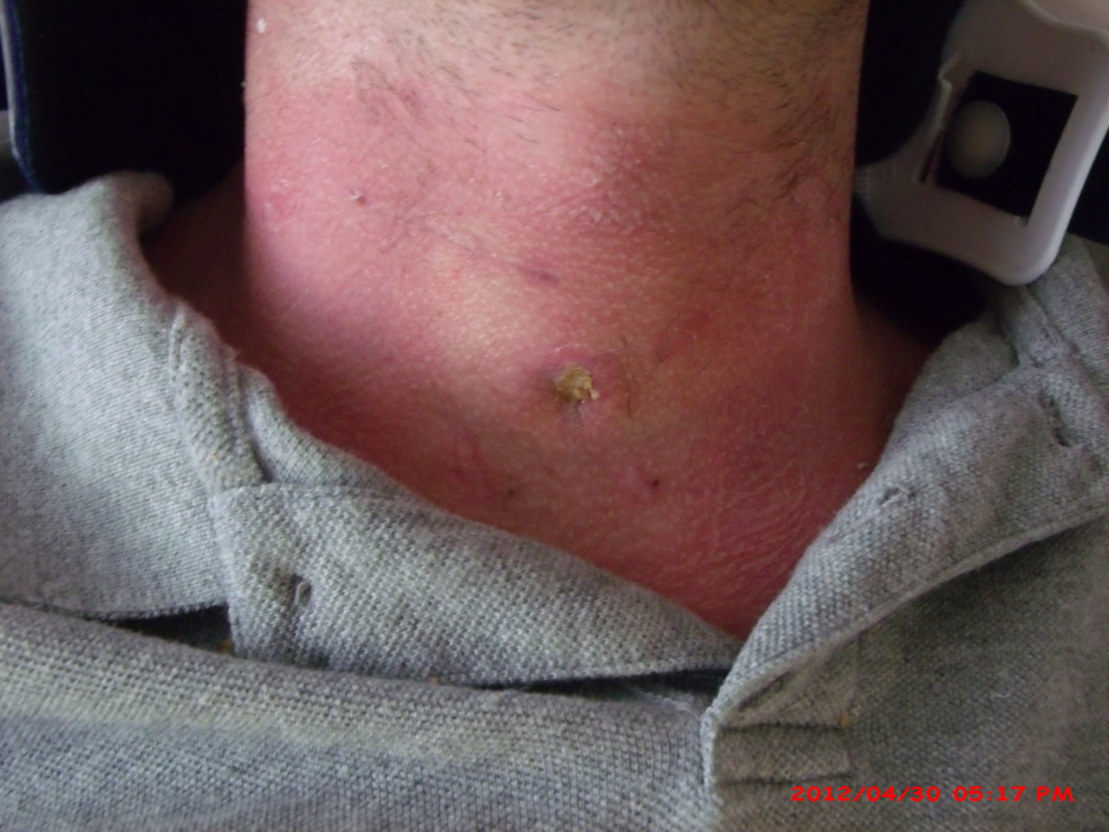 Danny: The trach hole :) Healing up and uncovered for good!