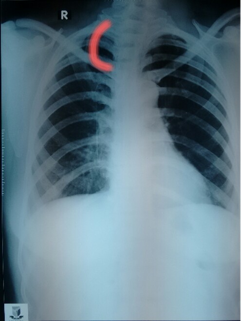 Chest Medicine Made Easy-Dr Deepu: The cervical rib