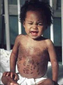 My world: Kekurangan Energi Protein