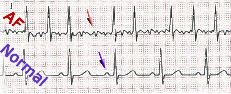 Med in Small Doses - SVT Tachyarrhythmias - IVLine