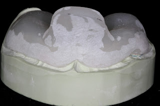 Boise Idaho Prosthodontics: Edentulous Custom Tray for PVS Impression ...