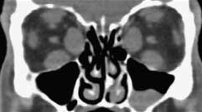 docteur: Orbitopathie endocrinienne d’origine thyroïdienne