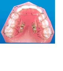 DISEÑAR APARATOLOGIA: PLACAS DE HAWLEY CON TORNILLOS DE EXPANSION