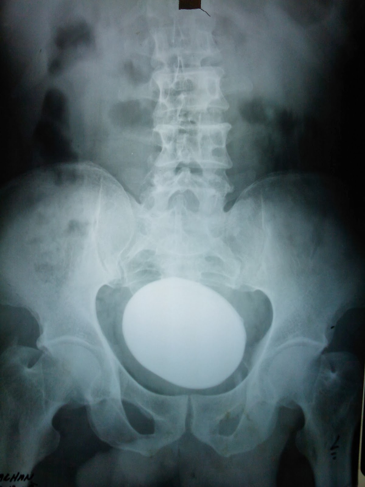 dokter wahyu spesialis bedah: batu buli buli