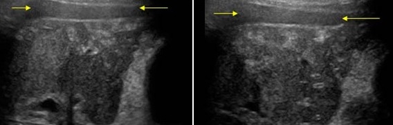 Ultrasound Hepatitis - Radiology Imaging