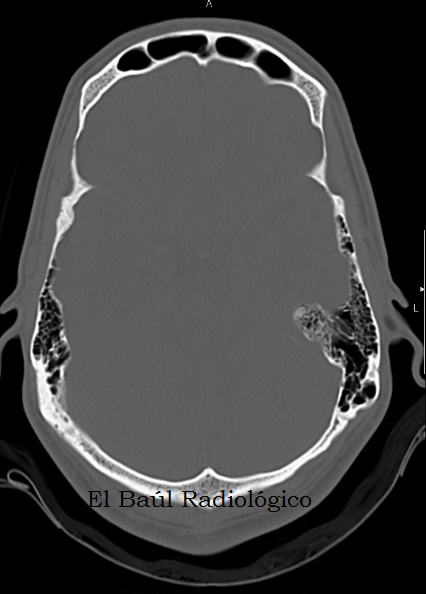 El Baúl Radiológico: HIPERNEUMATIZACIÓN DE LOS HUESOS TEMPORALES Y DE ...