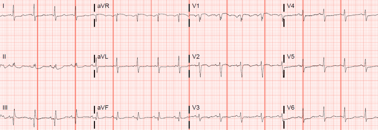Two EKG patterns of pulmonary embolism which mimic MI