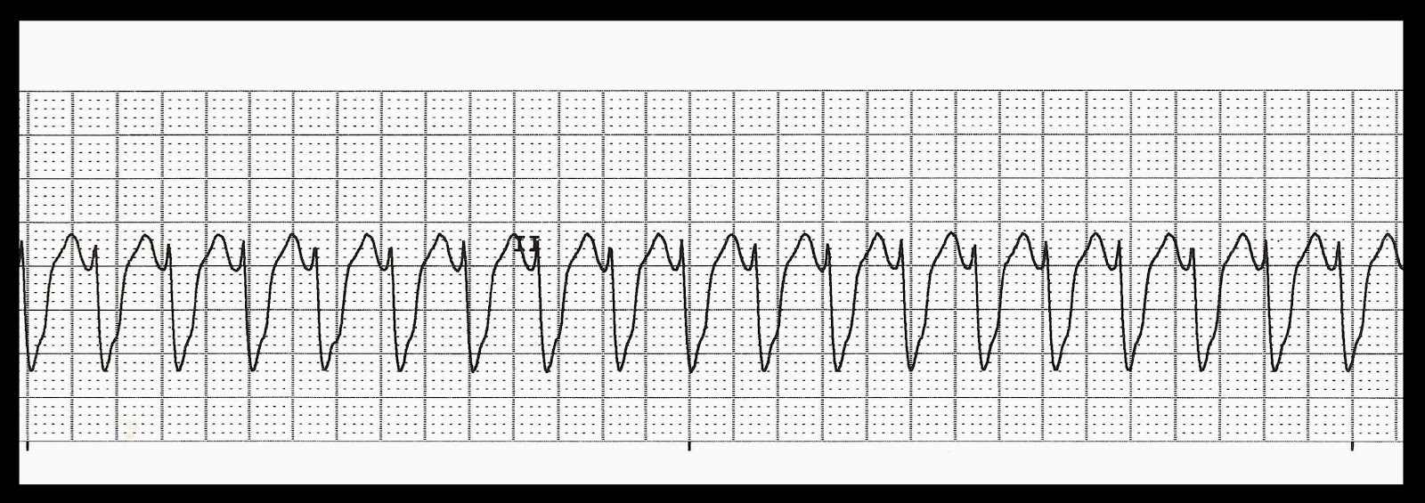 Basic EKG Rhythm Test 22