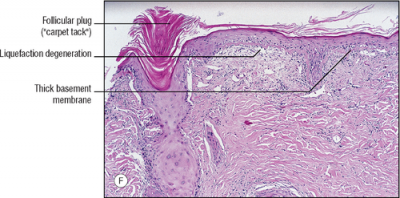 Discoid Lupus Erythematosus Histopathology