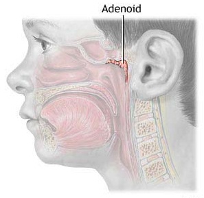 Hipertrofi Adenoid | Health Care