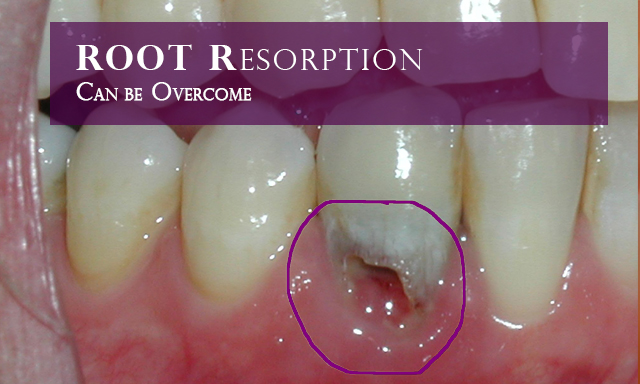 How Root Resorption Can Be Overcome ~ Dental Blog: Latest Dental News ...