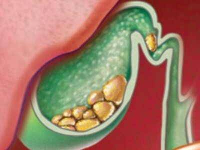 CHOLELITHIASIS AND CHOLECYSTITIS ~ Nursing Path