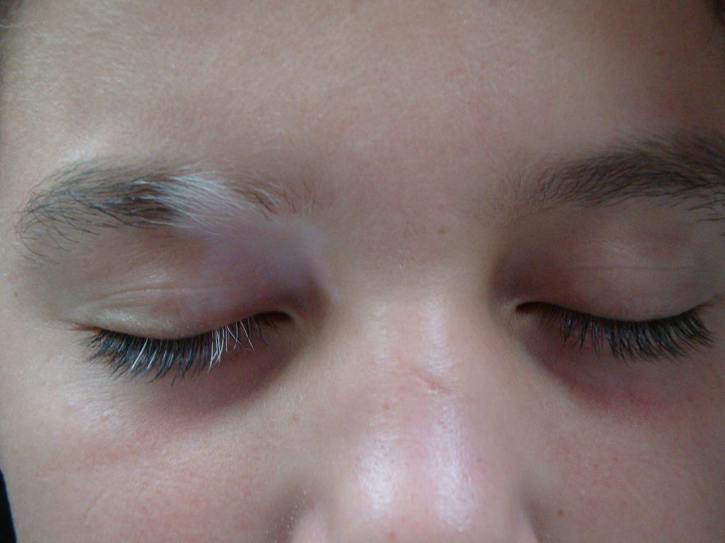 Deformutilation: Piebalism