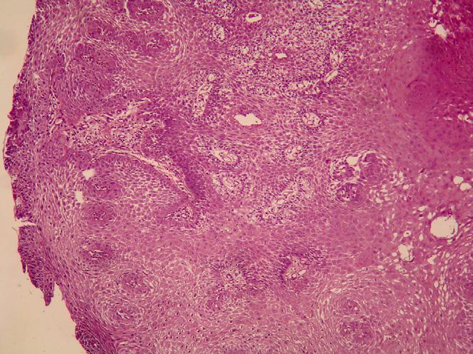 Lésion blanche de la muqueuse buccale ~ Médecine en français