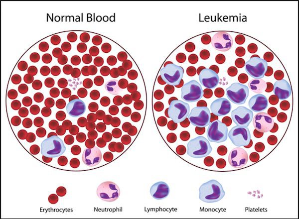 Apa Itu Penyakit Leukimia: Penyebab, Jenis, Gejala - Pasien Sehat