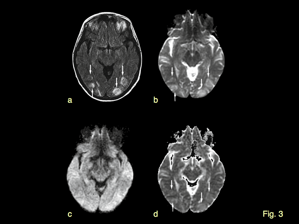 MRI BLOG: Pitfalls of Diffusion Weighted Imaging