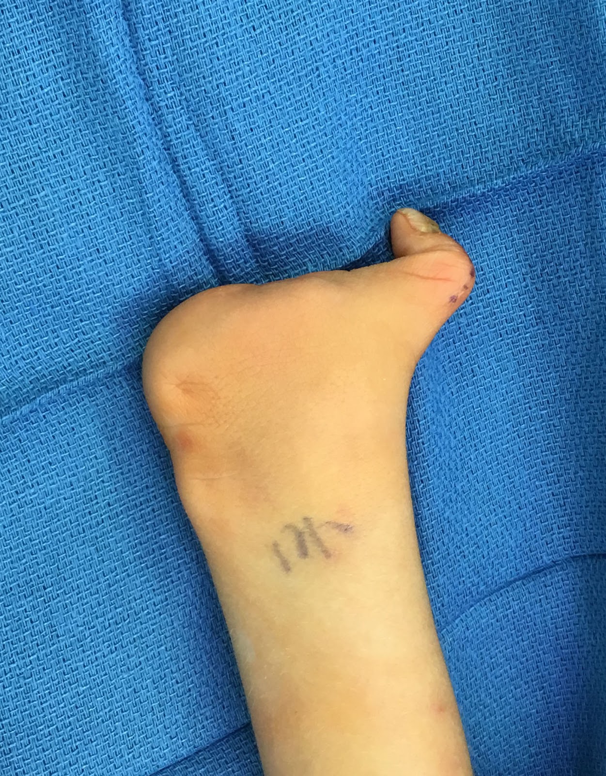 Simple Surgery for Symbrachydactyly | Congenital Hand and Arm ...