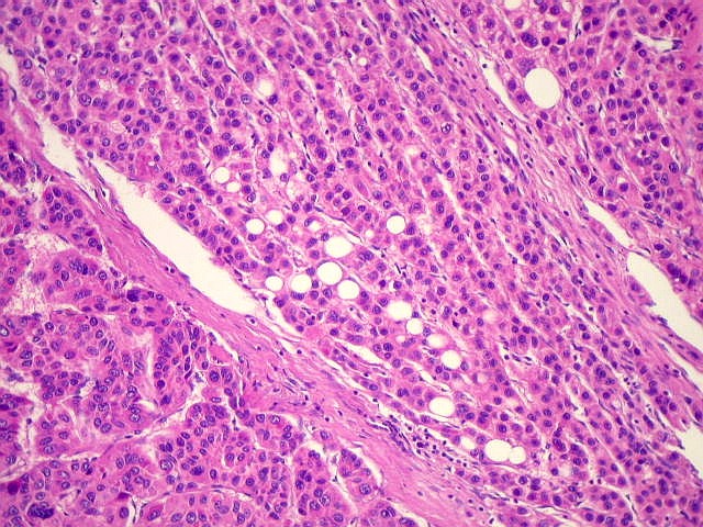 Atlas virtual de histologia e patologia: O QUE SÃO NEOPLASIAS?