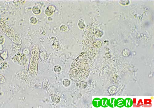 Atlas of Casts in urine | Free Medical Atlas