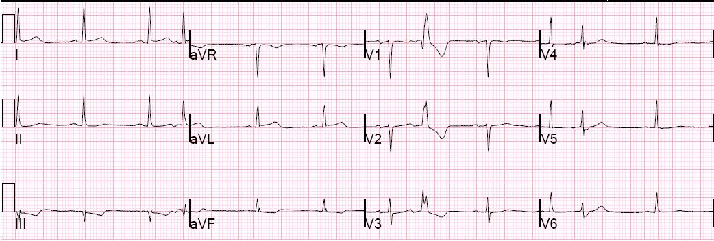 Dr. Smith's ECG Blog: Apparent ST depression in lead III. Is it MI?