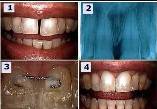 Omni Dental Group: Splinting Teeth
