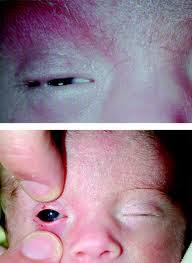 GEDR: Sindrome de Hay Wells