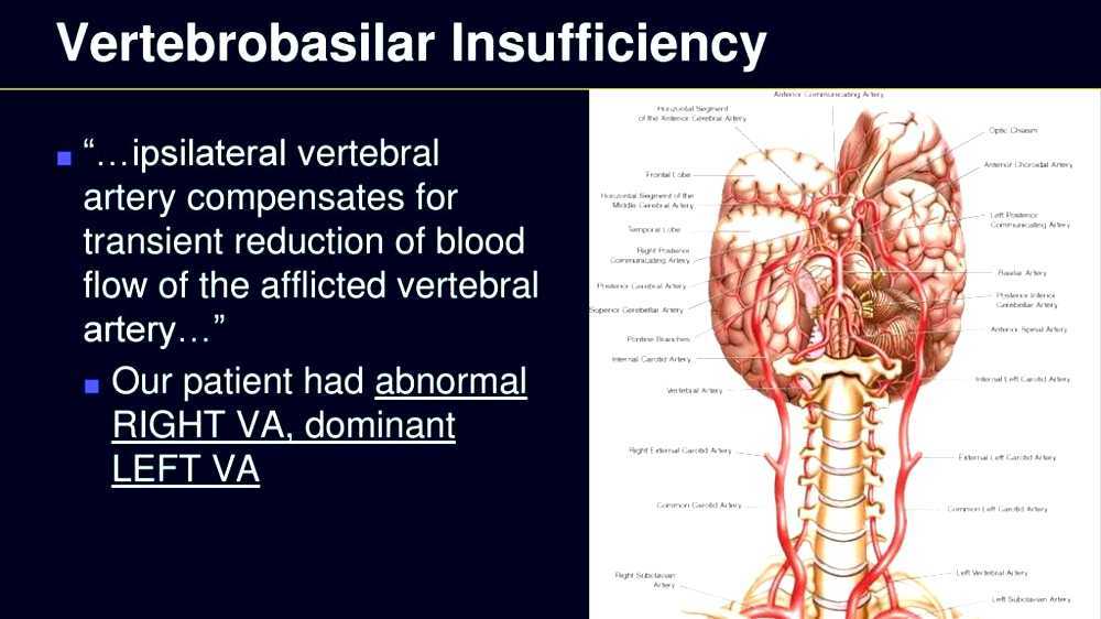 Vertebrobasilar insufficiency