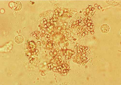 [Haematology] Microscopic Examination of Urinary Sediment ...