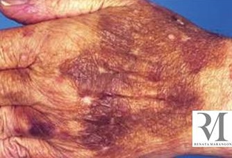 Fisioterapia em Pós Operatório de Cirurgias Plásticas: Hematoma ou ...