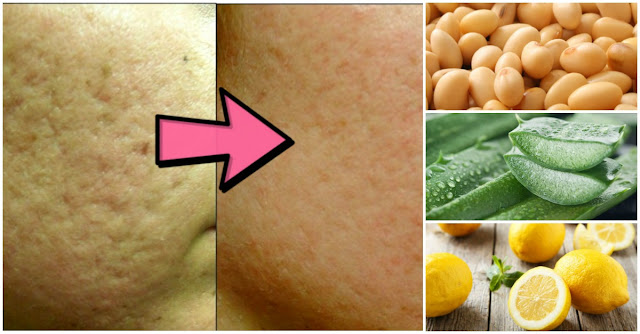 Nggak Pede Sama Muka Bopeng?? 9 Cara Ini Bisa Cepat Menghilangkannya Nih