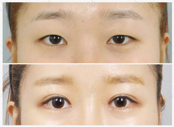 ID Hospital Korea: Eyelid surgery recovery process, tips & photos