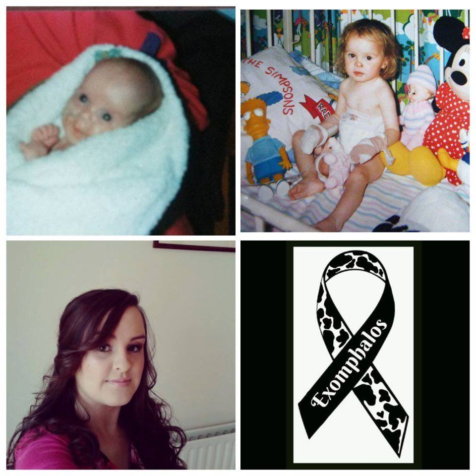 Exomphalos / Omphalocele Awareness