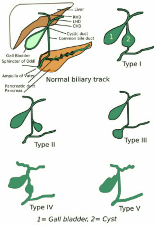 Mom2K's World: KISTA DUKTUS KOLEDOKUS