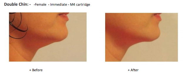 Aesthetics 101 (Part 5): Introduction to HIFU (High Intensity Focused ...