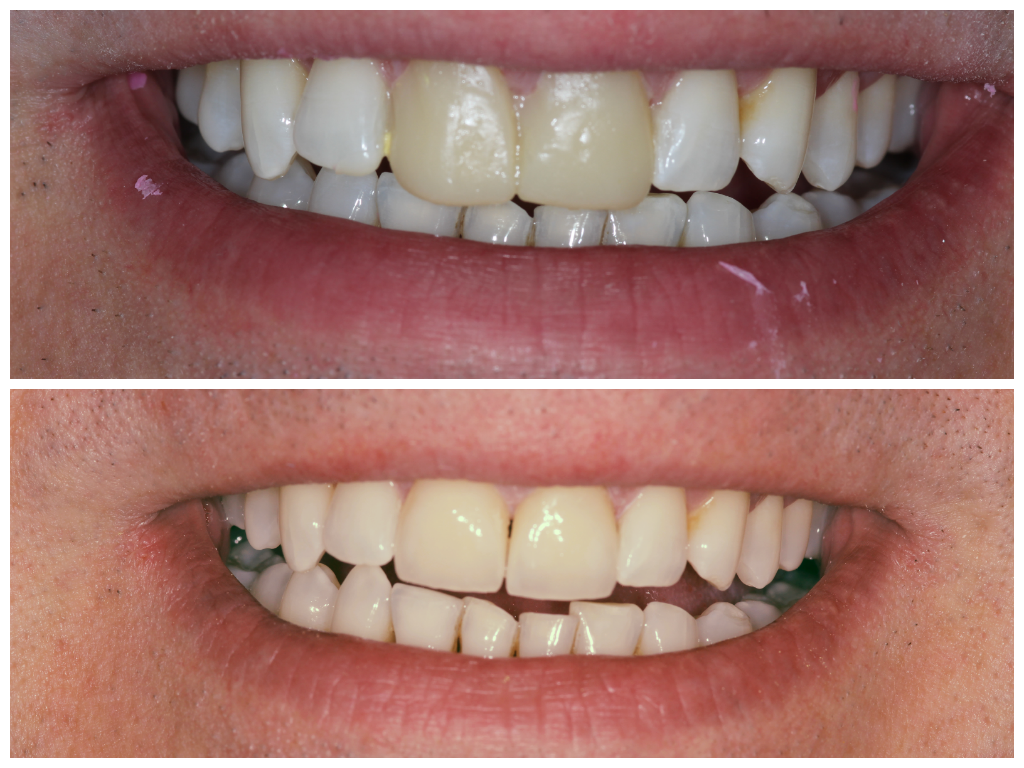 The Windsor Dental Blog: Do you have unsightly old crowns, veneers or ...