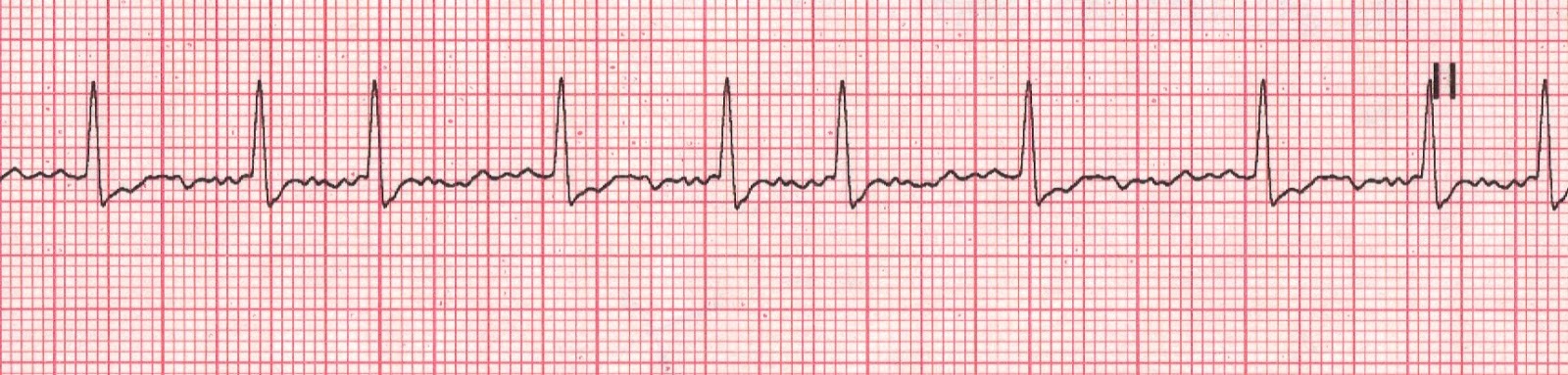 Atrial Fibrillation and Atrial Flutter